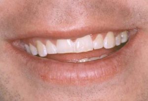 Grinding and Occlusal Splints